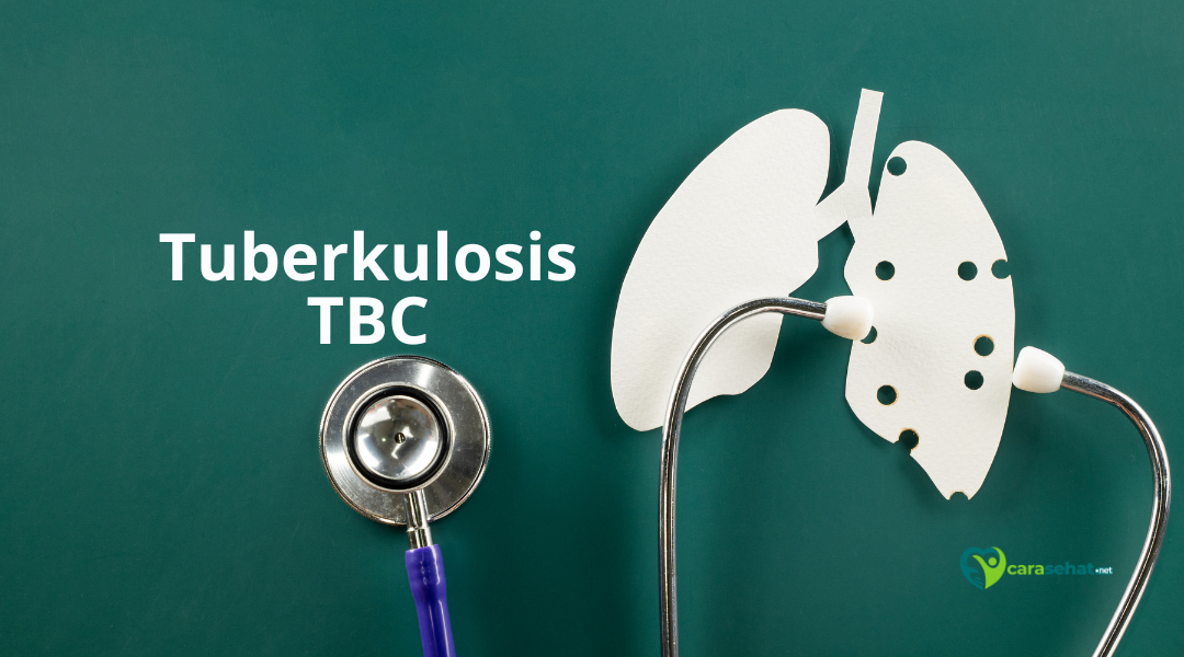 Tuberkulosis (TBC): Gejala, Penyebab, Pemeriksaan hingga Pengobatan ...